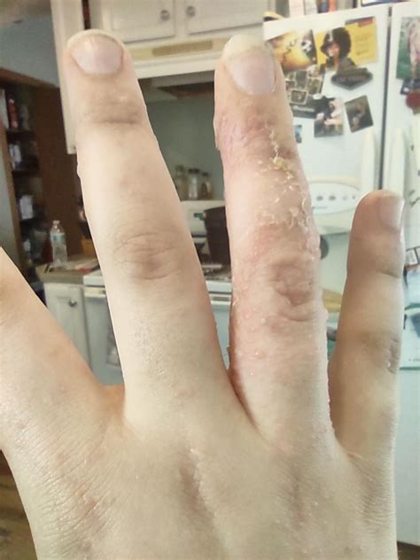 Dyshidrosis Infected Dyshidrosis Rdyshidrosis