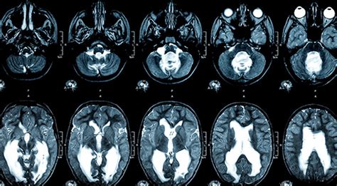 David Limbrick Md Phd Brain Immunology And Glia Washington University In St Louis