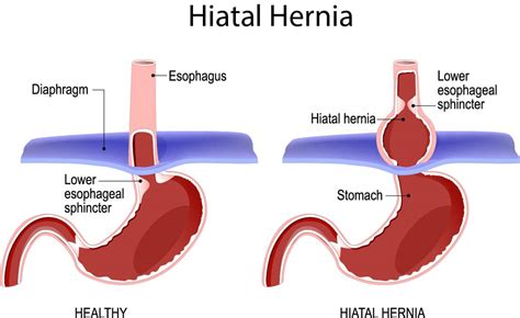 Hiatal Hernia Symptoms And Treatment A Laparoscopic View Posterior