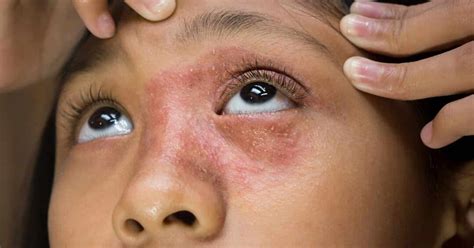 Contact Dermatitis Types Symptoms Causes And Treatment Allergy And Asthma Network