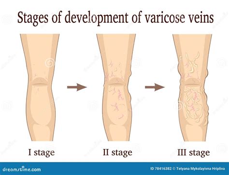 Stages Of Varicose Veins Disease Infographic Cartoon Vector