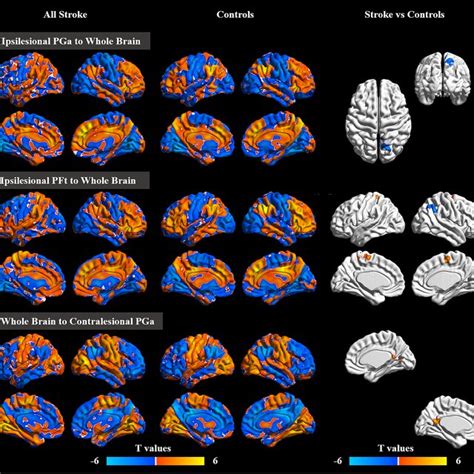 Disrupted Effective Connectivity Between Stroke Patients Presenting Download Scientific Diagram