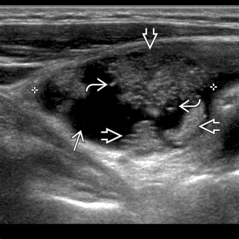 Malignant Cervical Lymph Nodes Radiology Key