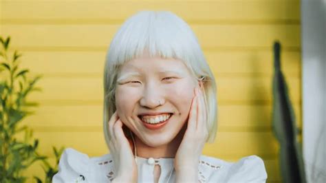 Understanding Albinism A Complete Guide To Causes Symptoms And