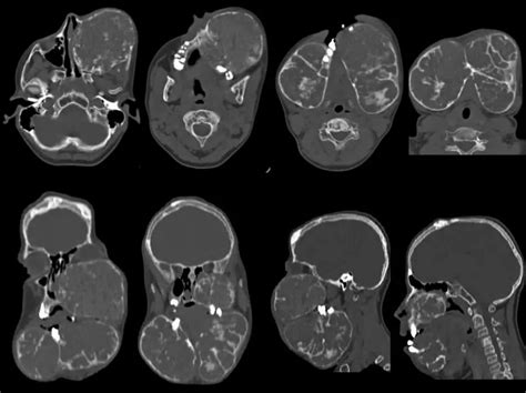 Image Iq Quiz Thickened Abnormal Bone Formation That May Involve The Skull