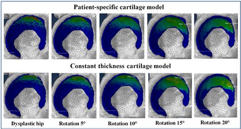 Contact Pressure Distribution Obtained By Using Two Different Cartilage
