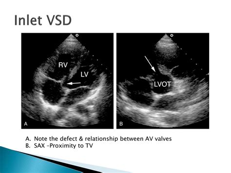 Ppt Echo Assessment Of Vsd Powerpoint Presentation Free Download Id 194552