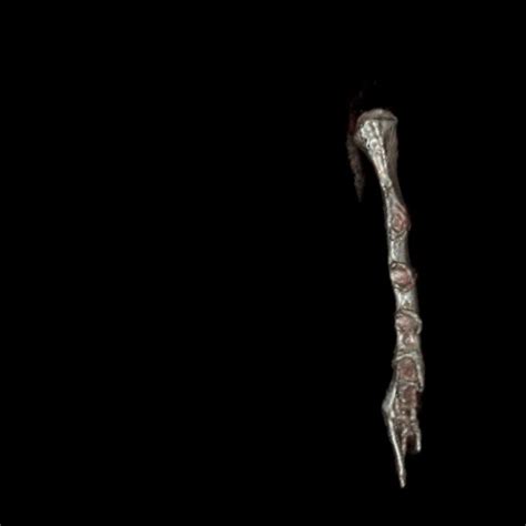 Radiopaedia Case Sternal Foramen Id 98515 Study 119181 Nc Commons