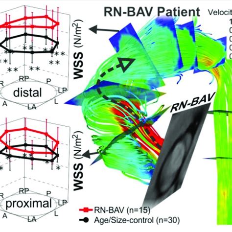 4d flow and wss quantification in 15 rn bav patients found that 4d flow