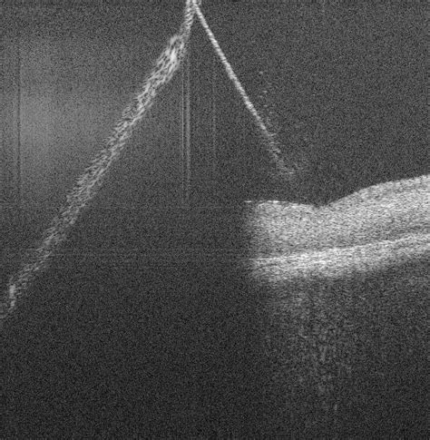 Jhu Oct Roboflow Universe