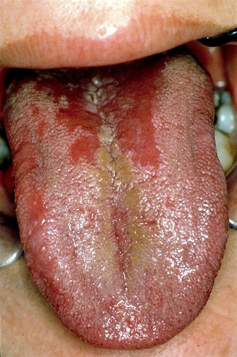 Oral Adverse Effects Drug‐induced Tongue Disorders Pmc