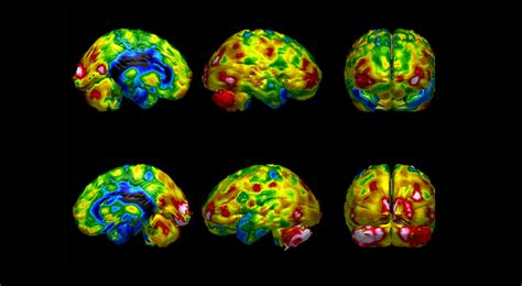 Revolutionizing Brain Health With Spect Scans Aviv Clinics