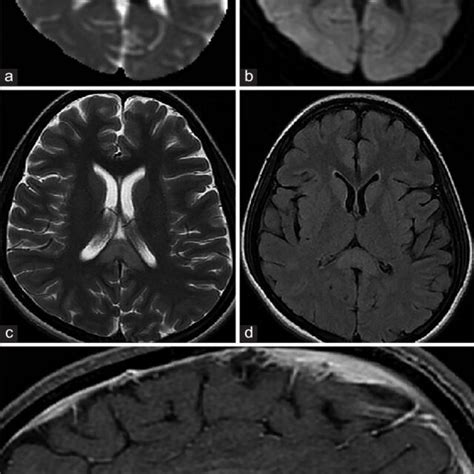 Mri Of Brain Showing Low Adc Value A And Diffusion Restriction B In Download Scientific