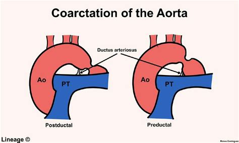 Pin By Nonas Arc On Coarctation Of The Aorta Coarctation Of The Aorta