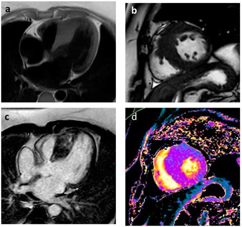 Arrhythmic Risk Stratification Among Patients With Hypertrophic