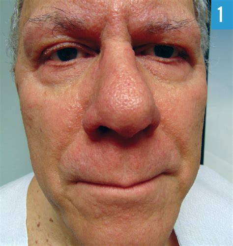 What Explains A Mans Papular Eruption And Madarosis After Cardiac Transplant Consultant