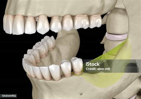 만지성 턱 어금니 치아를 잃은 후 뼈 경기 침체 의학적으로 정확한 치과 3d 일러스트레이션 감소에 대한 스톡 사진 및 기타 이미지 Istock