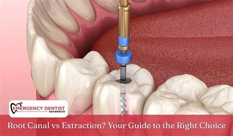 Root Canal Vs Extraction Your Guide To The Right Choice