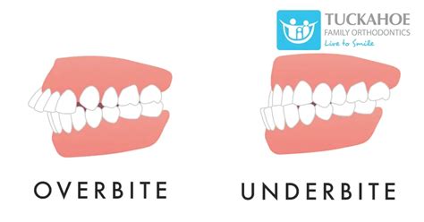 Overbite Vs Underbite Underbite Symptoms And Causes Fxxf
