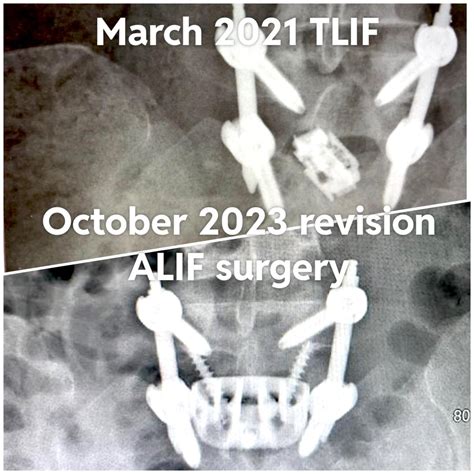 Spinal Anesthesia Possible With A Fused Spine Rspinalfusion