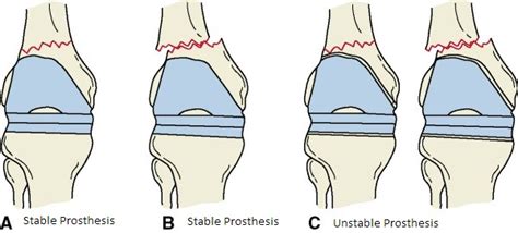 Adult Knee Radiographic Evaluation Recon Orthobullets