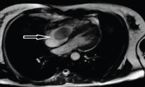 Cardiac Mri Confirms The Mass In A The Right Atrium With Prolapsing