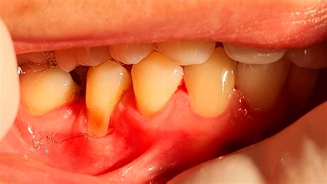 Você sofre sensibilidade nos dentes Já ouviu falar em retração gengival e LCNC lesão dental