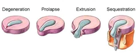 Bulging Disc Herniated Disc Back Pain Sydney Physio Clinic