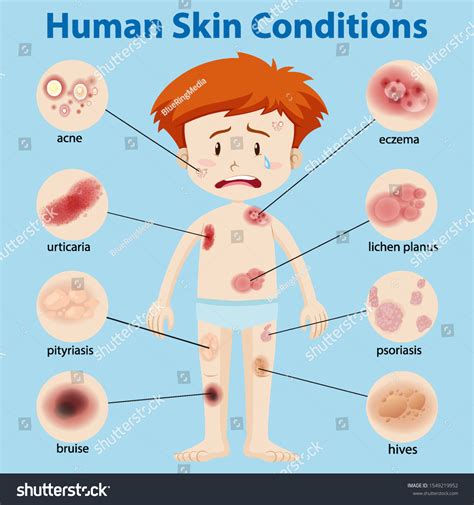 Diagram Showing Different Skin Conditions Illustration Stock Vector Royalty Free 1549219952