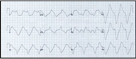 Hyperkalemia In A Young Woman With Type 1 Diabetes Mellitus