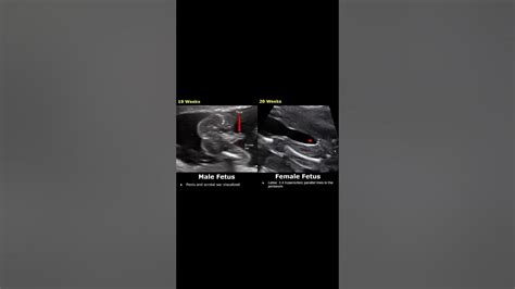 Fetal Gender Determination Ultrasound 19 32 Weeks Male And Female