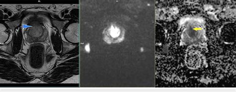 Biparametric Prostate Mri Of A 50 Year Old Patient Showing Diffuse Download Scientific Diagram