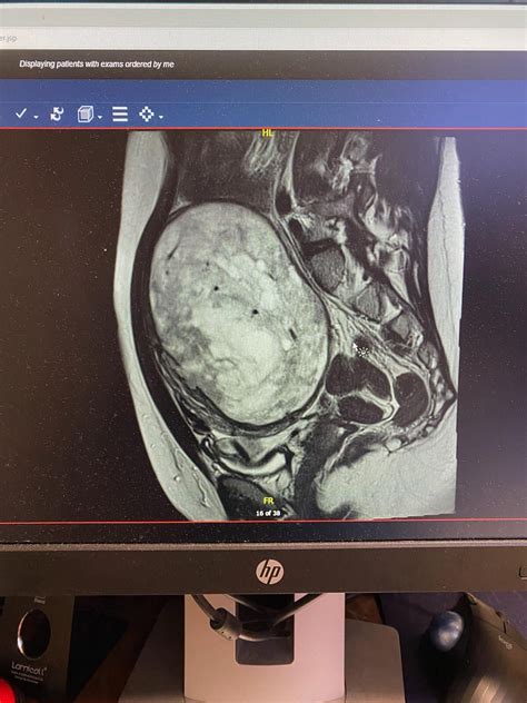 Sharing My Uterine Fibroid Embolization Ufe Story Rfibroids