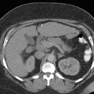 Computerized Tomography Scan Of The Abdomen And Pelvis Demonstrated