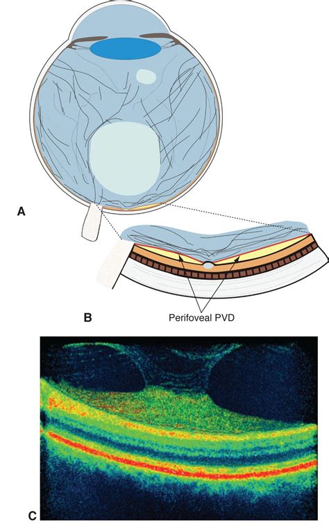 Retinal Tear Floaters