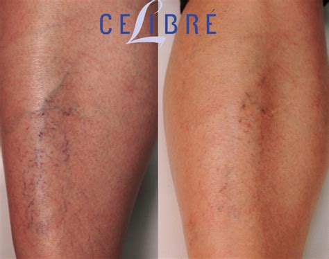 Laser Treatment For Spider Veins Cost