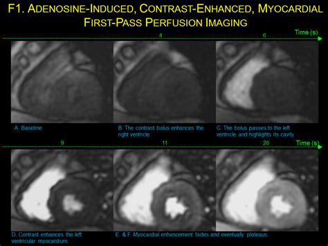 Myocardial Perfusion Cardiac Mri