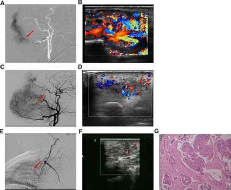 Representative Clinical Images At Diagnosis A C Dsa Detected A