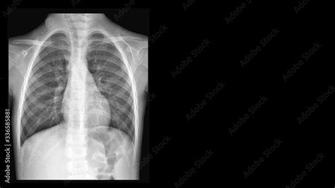 Film X Ray Chest Radiograph Cxr Show Perihilar Infiltration And Pleural Thickening This Cause