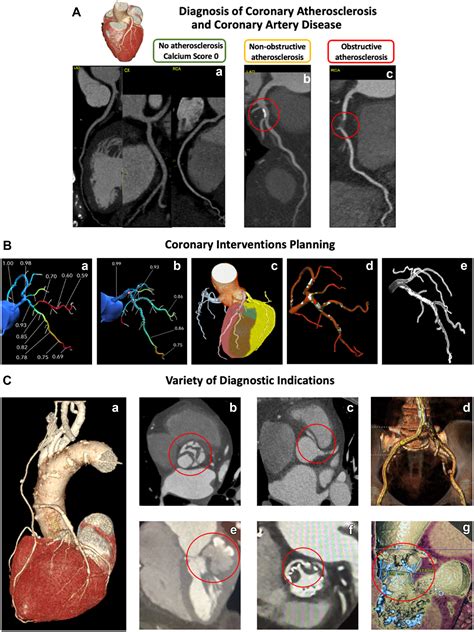 Cardiac Computed Tomographic Angiography In Cardiovascular Disease A Diagnostic Imaging