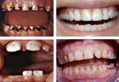 Teeth Abnormalities 24 48 Flashcards Quizlet