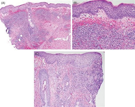 Median Rhomboid Glossitis Histology