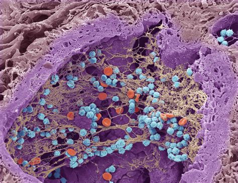 Appendicitis Sem Stock Image C057 2522 Science Photo Library