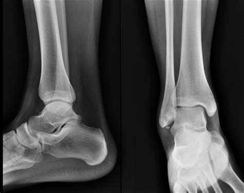 Os Subfibulare Radiology Case Radiology Radiology Imaging Ankle Surgery