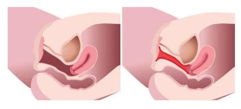 Laser Therapy Dallas Tx Prima Health Clinic Internal Medicine