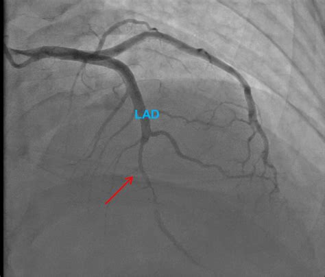 Type 2 Scad Involving The Mid To Distal Lad Artery Red Arrow Download Scientific Diagram