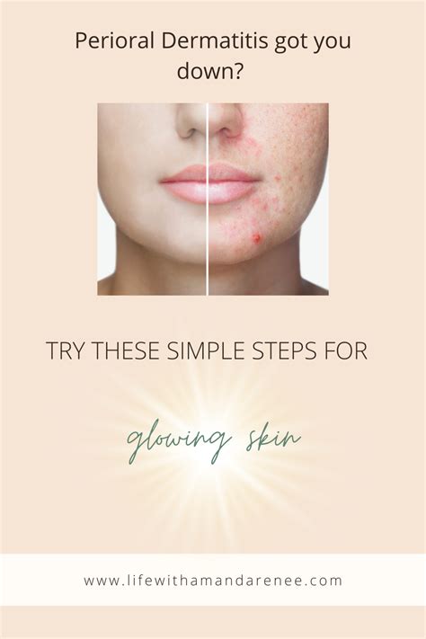 Perioral Dermatitis Treatment Artofit