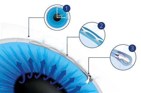 Hydrus Microstent Mivision