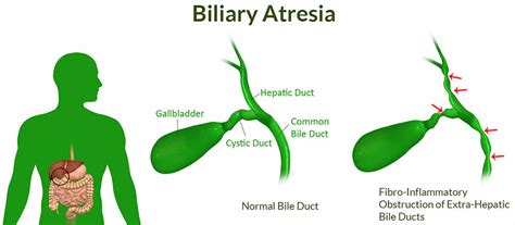 Biliary Atresia Causes Symptoms Prognosis And Biliary Atresia Treatment