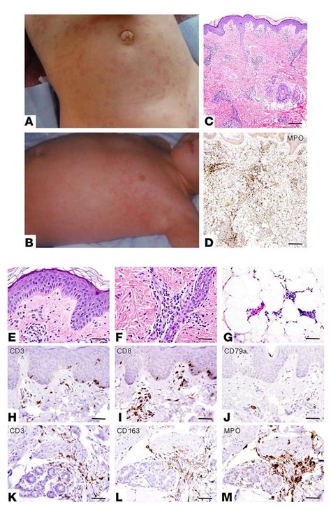 Jci Insight Redefined Clinical Features And Diagnostic Criteria In